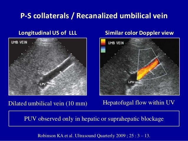 Doppler ultrasound of the portal system - Pathological findings