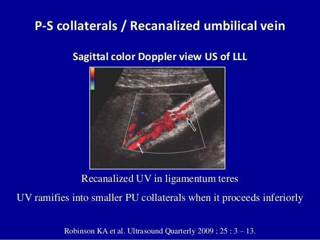 Doppler ultrasound of the portal system - Pathological findings