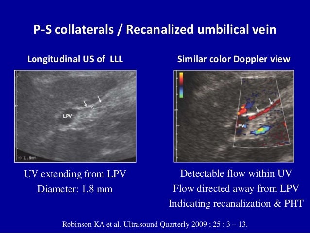 Doppler ultrasound of the portal system - Pathological findings