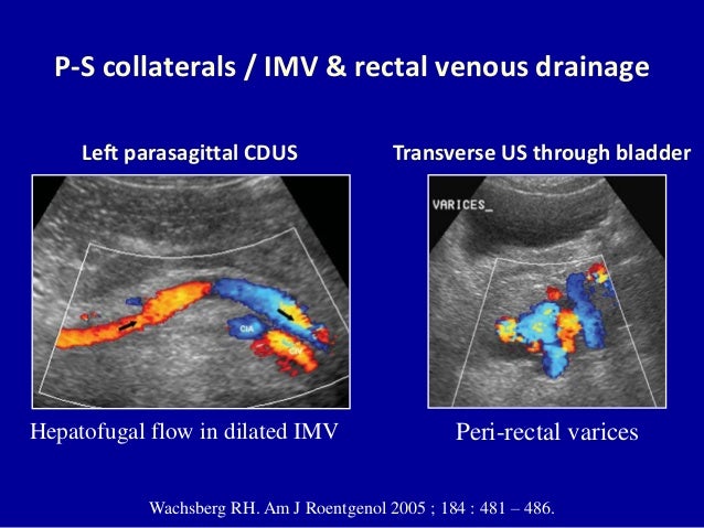 Doppler ultrasound of the portal system - Pathological findings