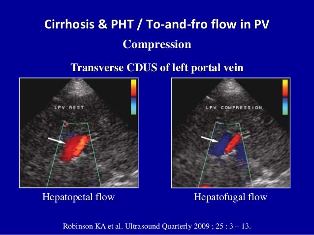 Doppler ultrasound of the portal system - Pathological findings
