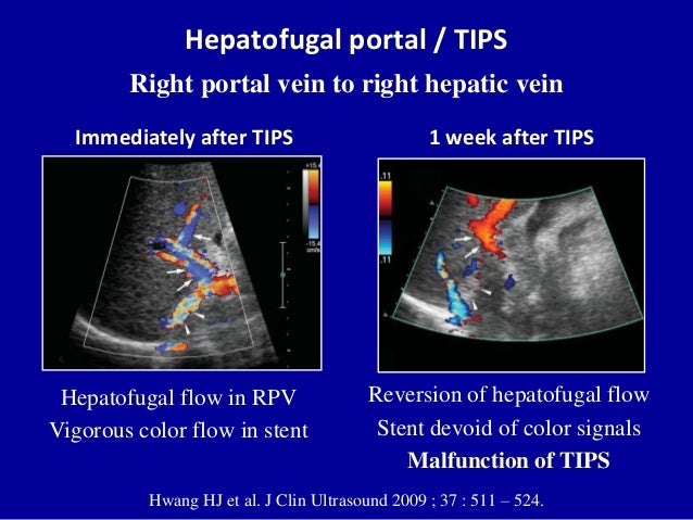 Doppler ultrasound of the portal system - Pathological findings