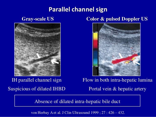 Doppler ultrasound of the portal system - Pathological findings