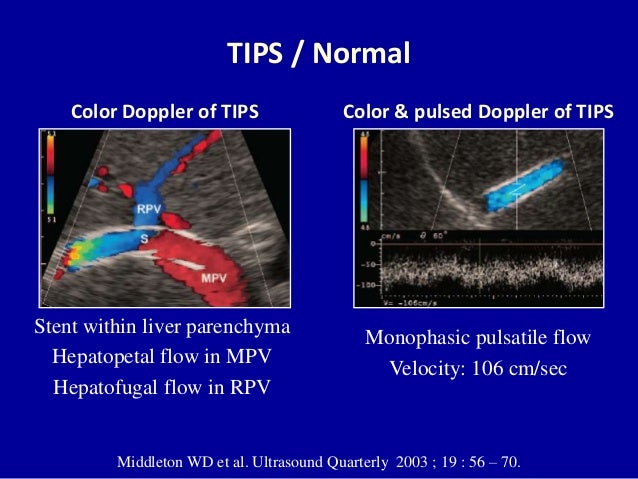 Doppler ultrasound of the portal system - Pathological findings