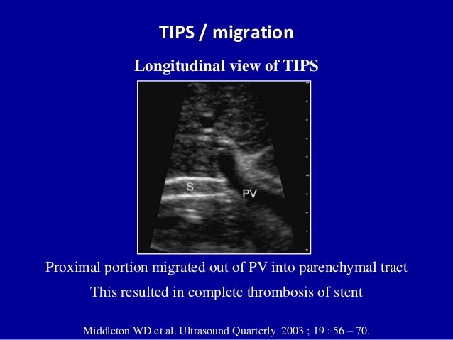 Doppler ultrasound of the portal system - Pathological findings