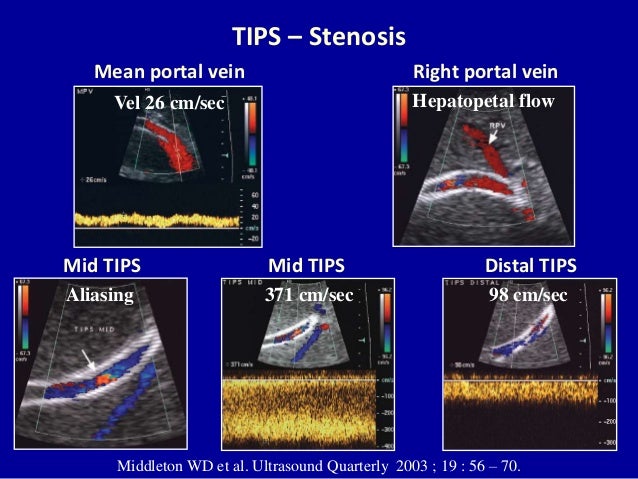 Doppler ultrasound of the portal system - Pathological findings