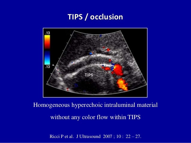 Doppler ultrasound of the portal system - Pathological findings