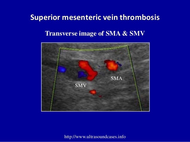 Doppler ultrasound of the portal system - Pathological findings