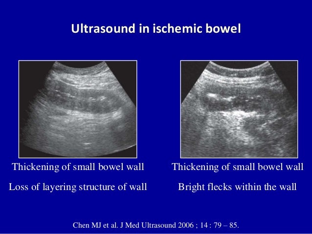 Doppler ultrasound of the portal system - Pathological findings