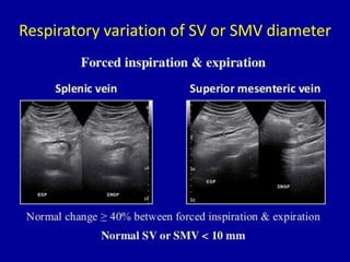 Splenic Vein Ultrasound