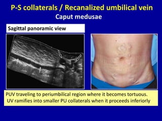 Doppler of the portal system pathologies | PPTX