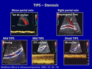 Doppler of the portal system pathologies | PPTX