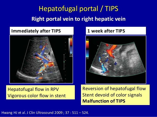 Doppler of the portal system pathologies