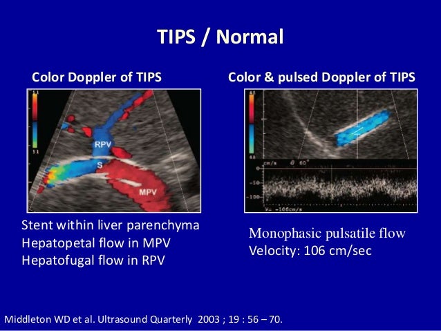 Doppler of the portal system pathologies