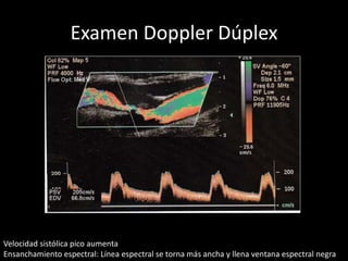 Doppler periorbitario | PPTX