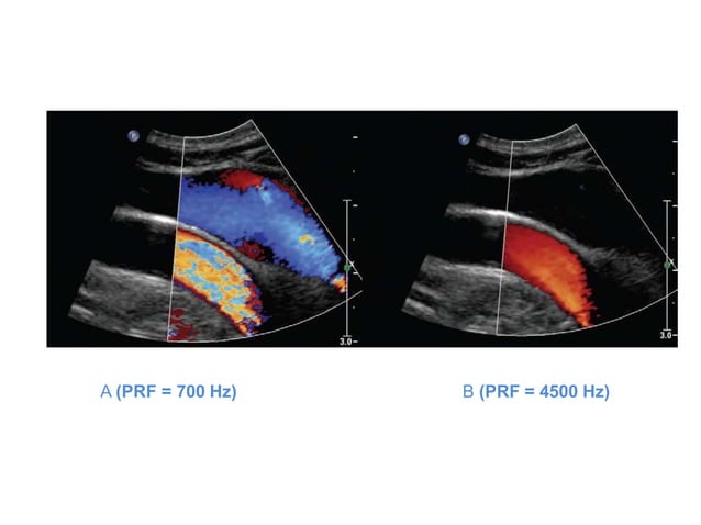 Color Doppler Ultrasound - Basic physics | PPTX | Physics | Science