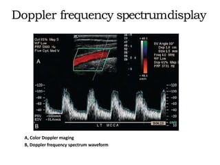 Color Doppler Ultrasound - Basic physics | PPTX