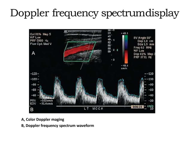 Color Doppler Ultrasound - Basic physics | PPTX | Physics | Science