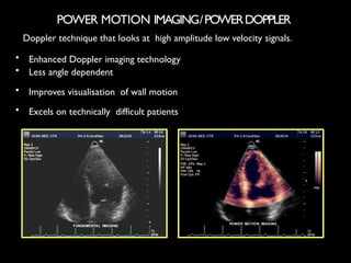 DOPPLER PHYSICS and interpretation of doppler waveform Presentation | PPTX
