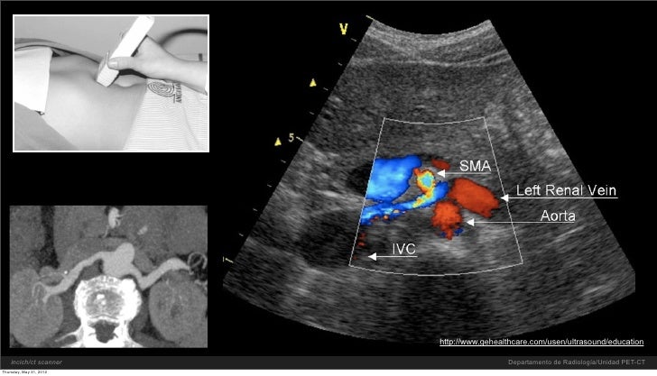 Renal artery doppler ultrasound - batmanjava