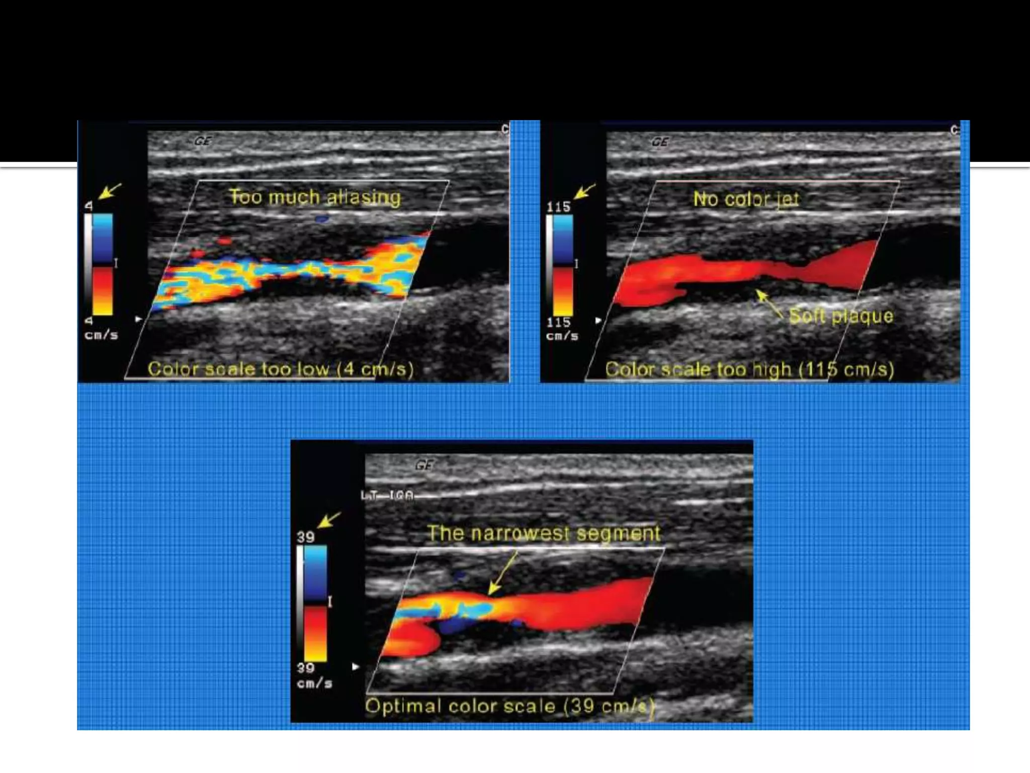Doppler study general bases | PPT