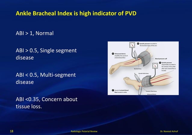 Doppler ultrasound in peripheral arterial disease | PDF | Heart and ...