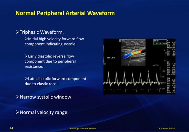 Doppler ultrasound in peripheral arterial disease | PDF | Heart and ...