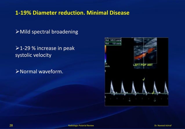 Doppler ultrasound in peripheral arterial disease | PDF | Heart and ...