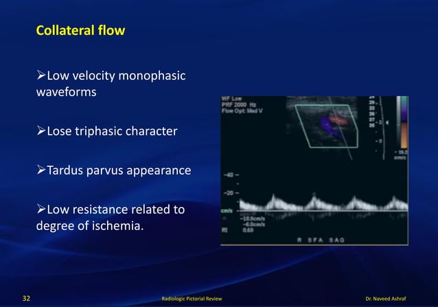 Doppler ultrasound in peripheral arterial disease | PDF | Heart and ...
