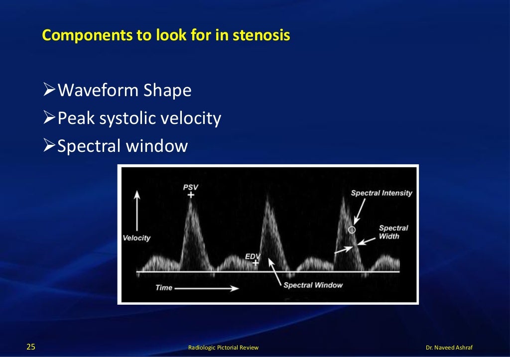 Doppler Ultrasound In Peripheral Arterial Disease doppler-ultrasound-in-peripheral-arterial-disease