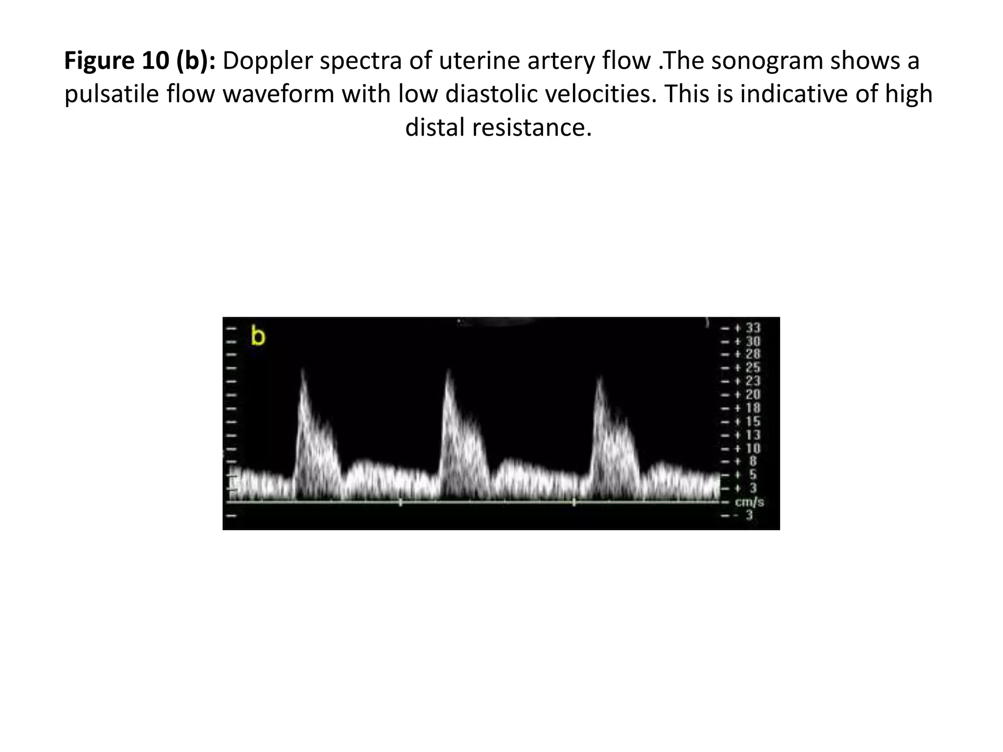 Doppler ultrasound (4) | PPTX