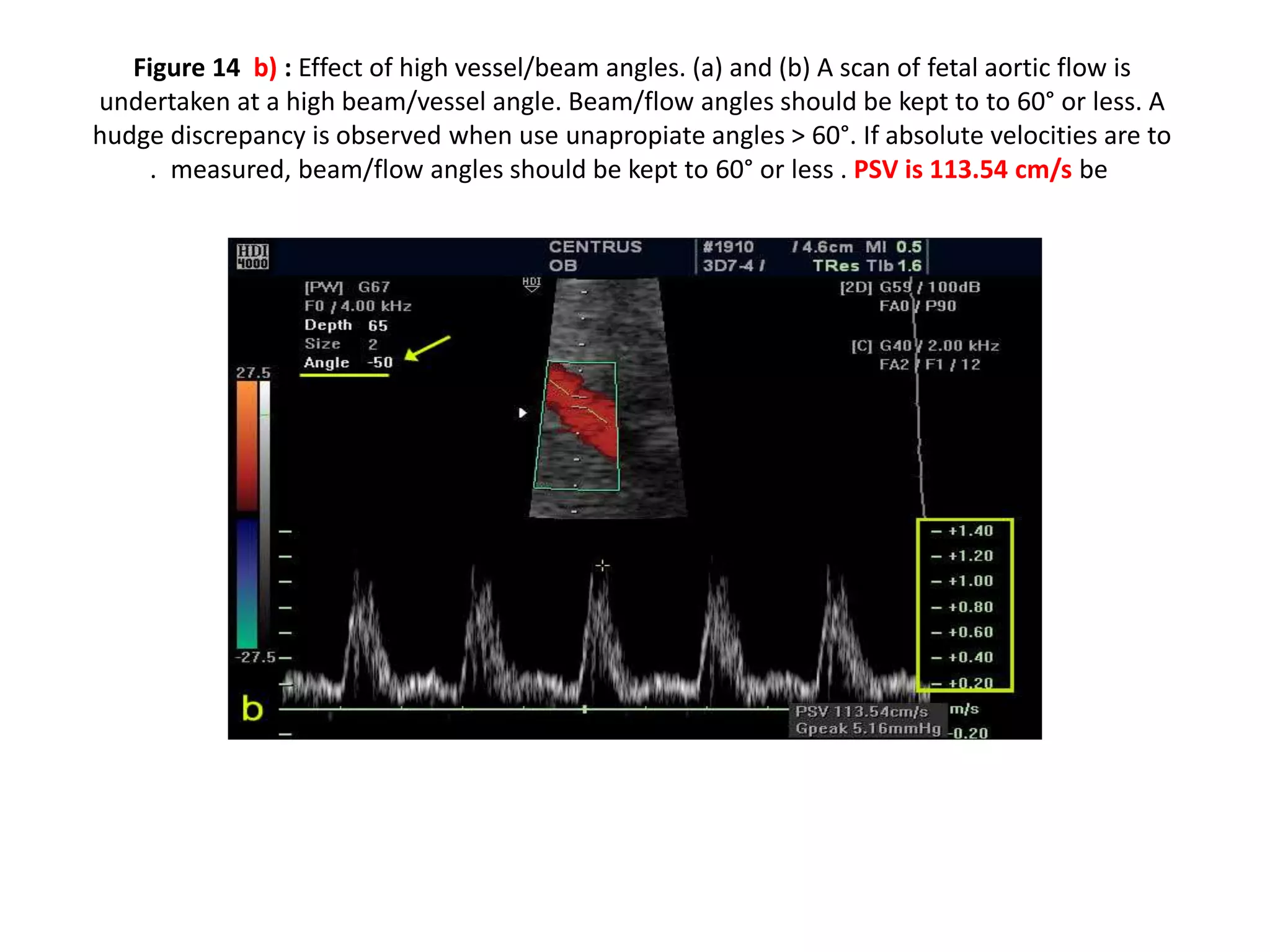 Doppler ultrasound (4) | PPTX
