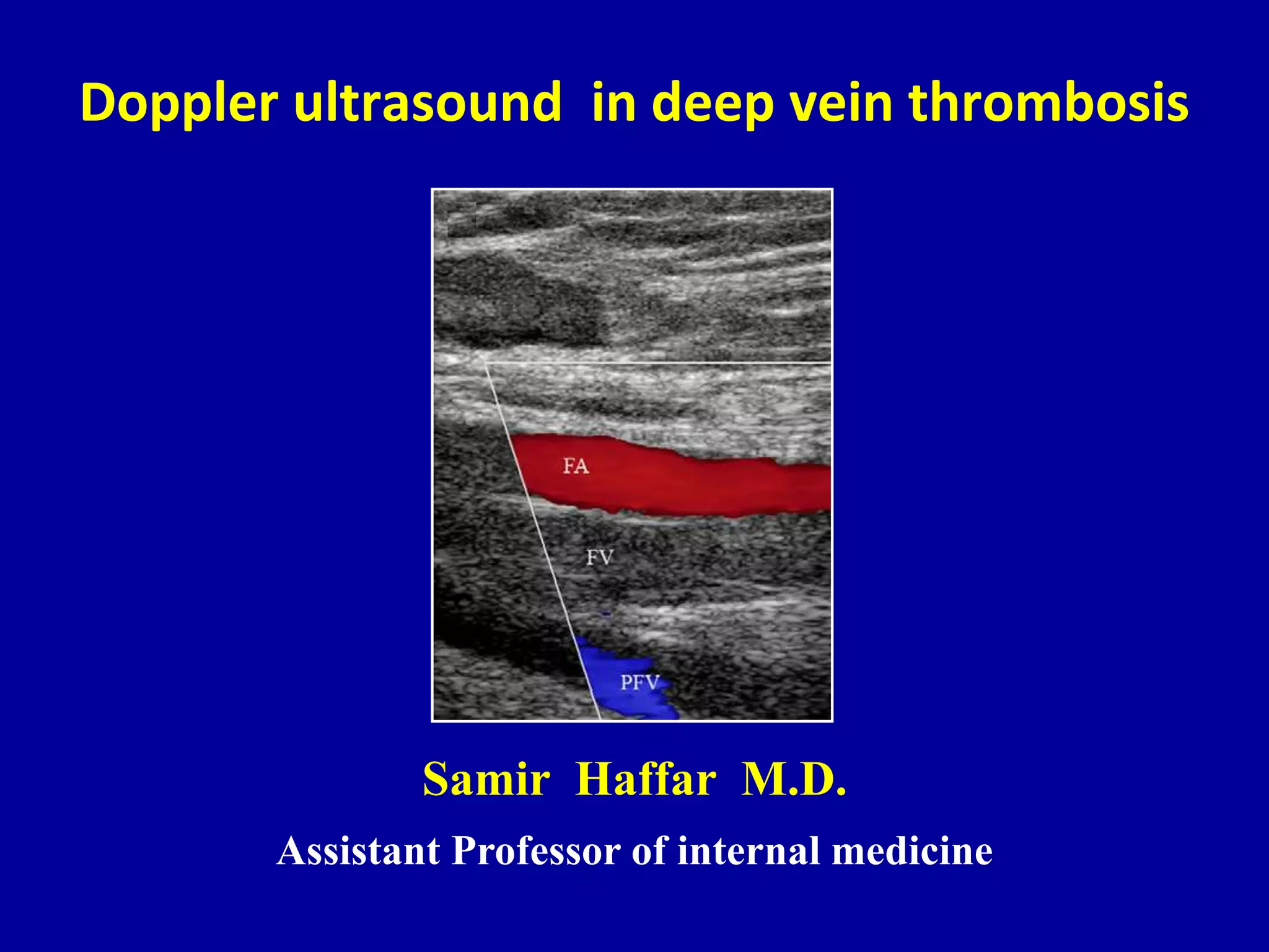 Doppler ultrasound in deep vein thrombosis | PPTX