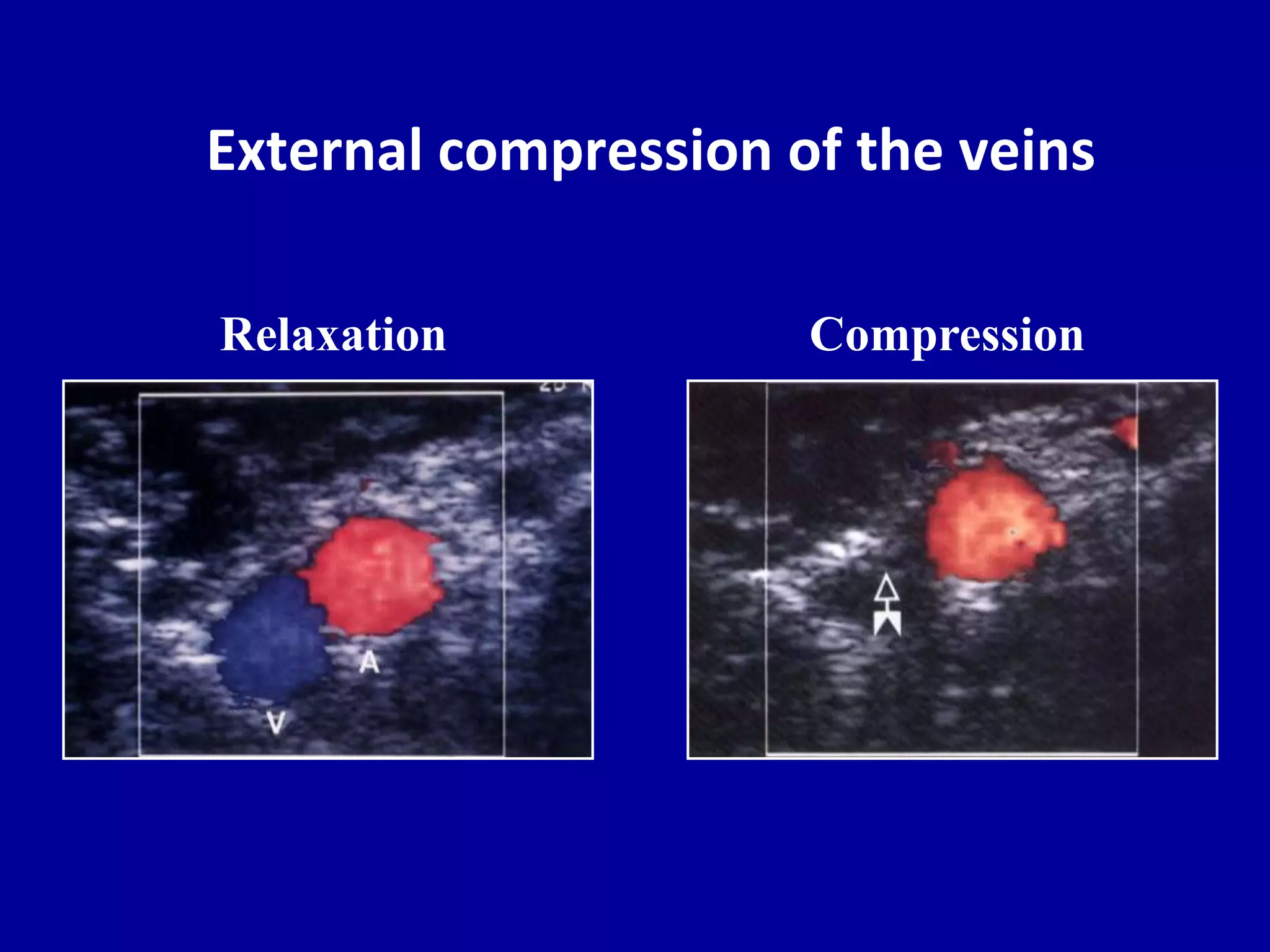 Doppler ultrasound in deep vein thrombosis | PPTX