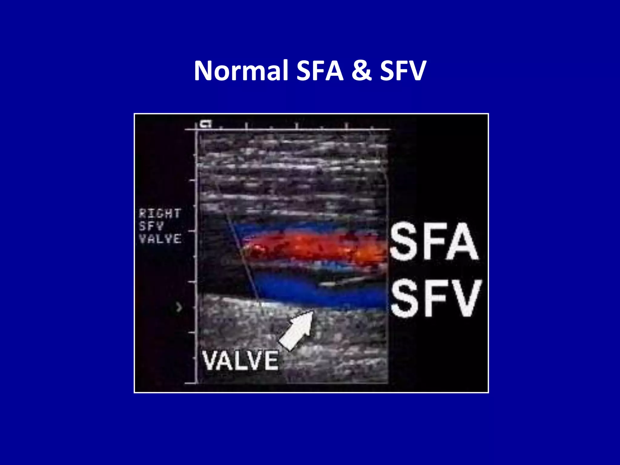 Doppler ultrasound in deep vein thrombosis | PPTX