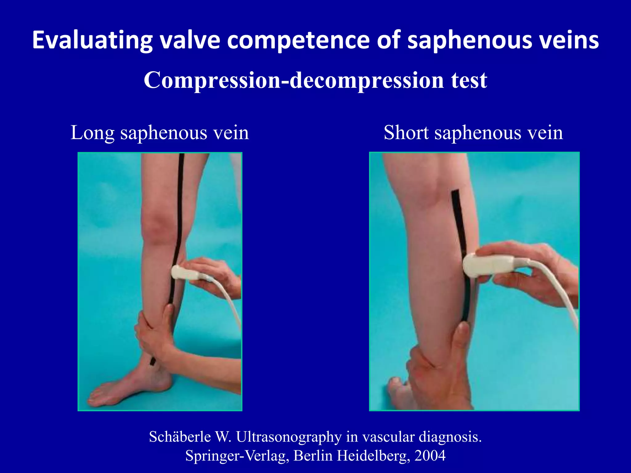 Doppler ultrasound in deep vein thrombosis | PPTX