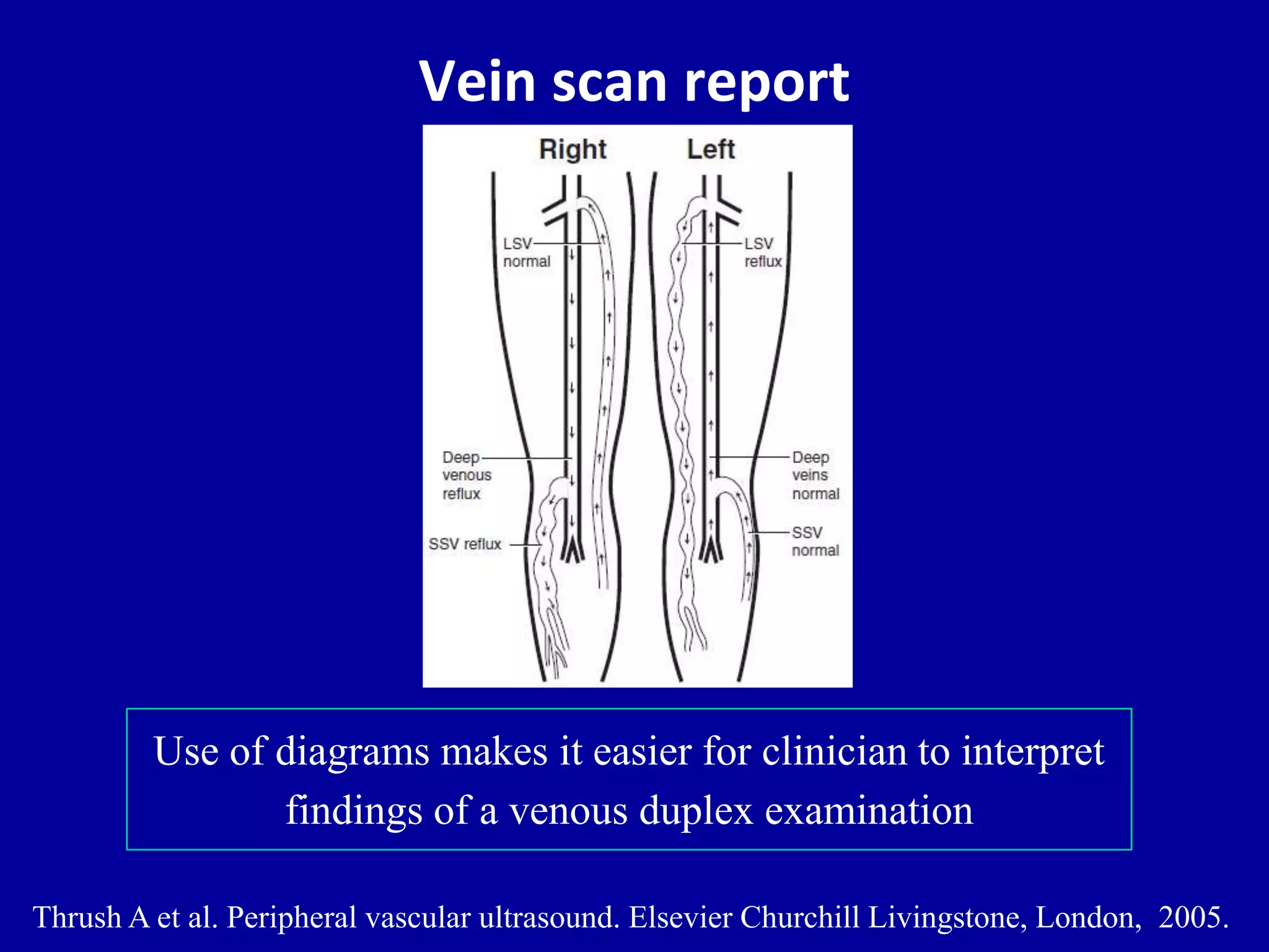 Doppler ultrasound in deep vein thrombosis | PPTX