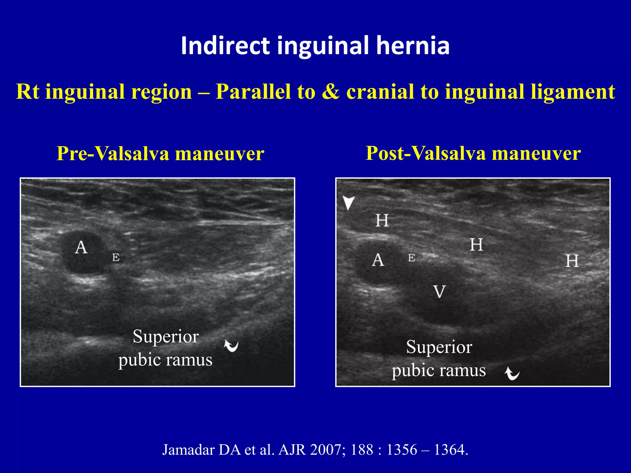Doppler ultrasound in deep vein thrombosis | PPTX