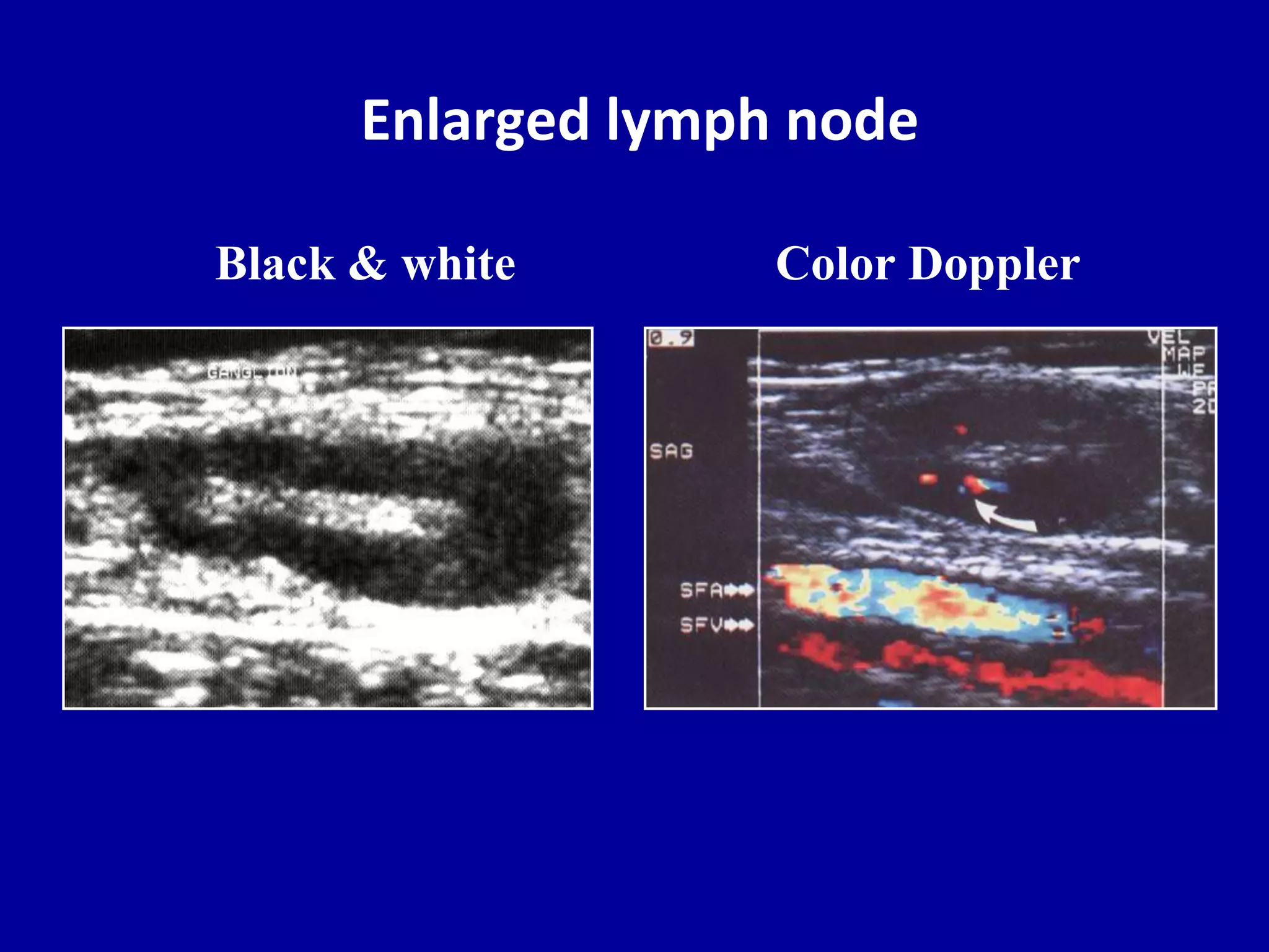 Doppler ultrasound in deep vein thrombosis | PPTX