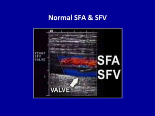 Doppler ultrasound in deep vein thrombosis | PPTX