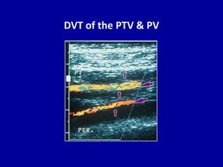Doppler ultrasound in deep vein thrombosis | PPTX | Medical Health