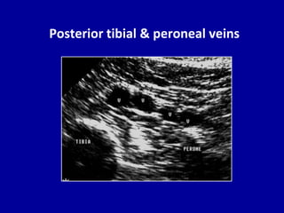 Peroneal Vein Ultrasound