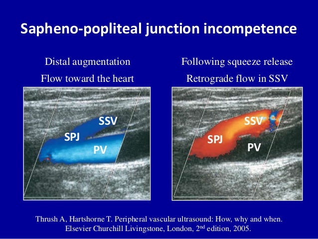 Doppler ultrasound in deep vein thrombosis