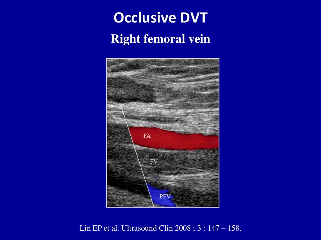 Doppler ultrasound in deep vein thrombosis