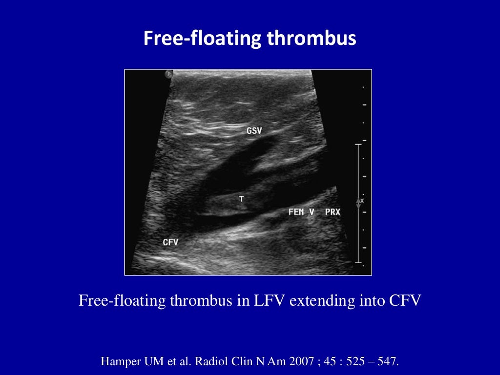 Doppler ultrasound in deep vein thrombosis