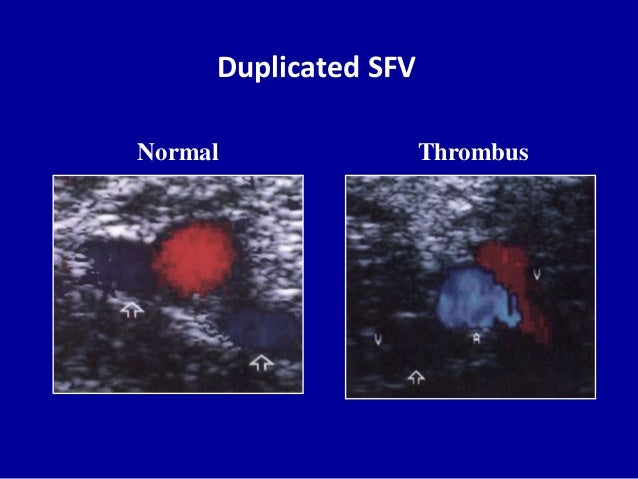 Doppler ultrasound in deep vein thrombosis