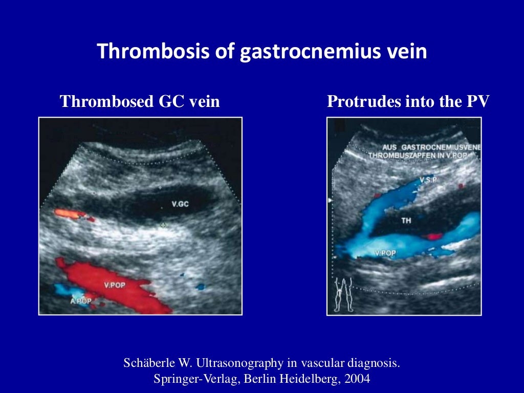 Doppler Ultrasound In Deep Vein Thrombosis