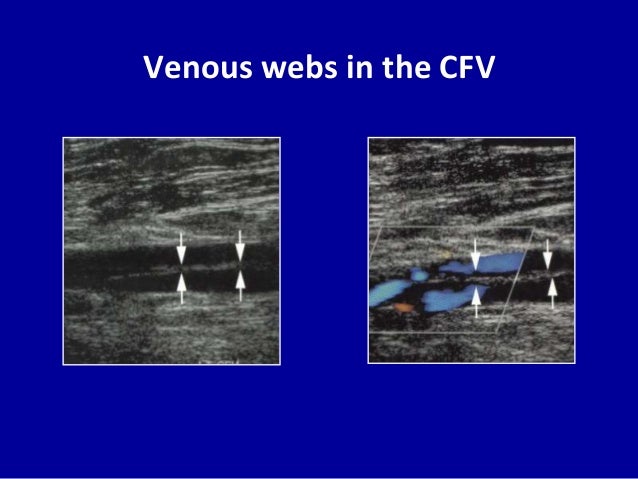 Doppler ultrasound in deep vein thrombosis