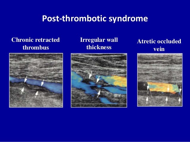 Doppler ultrasound in deep vein thrombosis