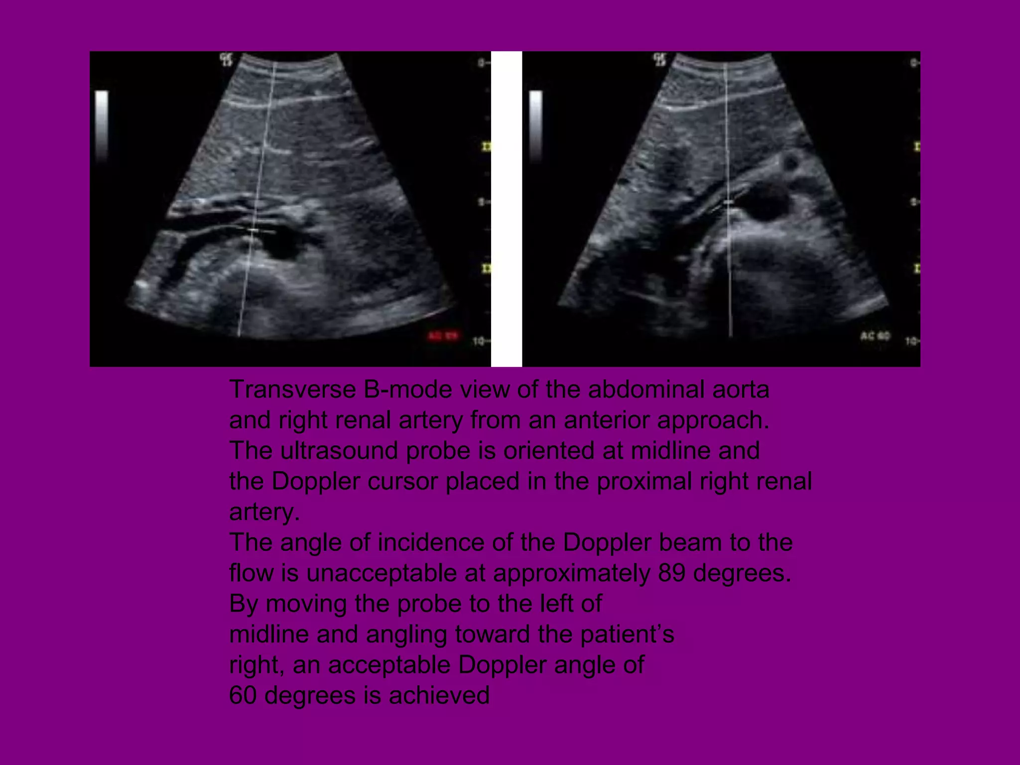 Doppler ultrasound in renal patients | PPT